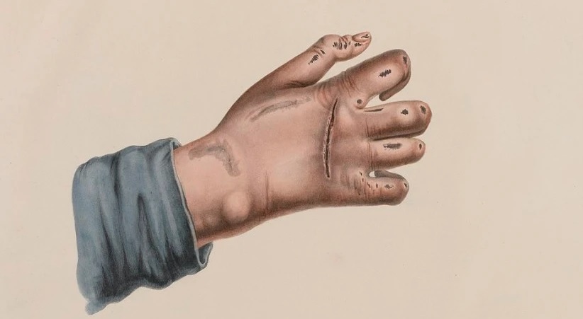 Guiné-Bissau - Estão a surgir novos casos de lepra. Doença que estava ...